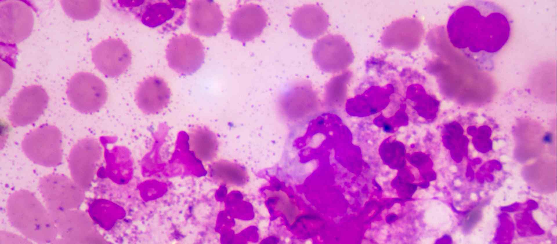 Expert: CMS Takes Significant Step to Improve Sepsis Care in 2024 IPPS ...